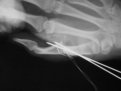 Dorsal Thumb Release, Arthrodesis and Extended Thenar Flap
