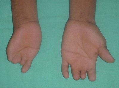 Hypoplastic Hands