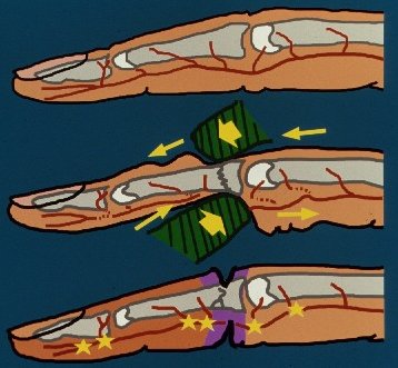 Slide Presentation: Severe Hand Trauma